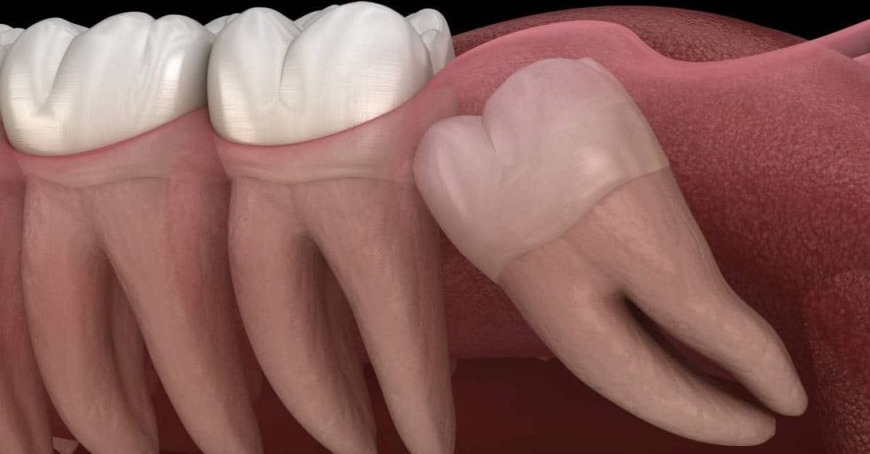 Wisdom Teeth Removal Gold Coast | Value Dental Centres