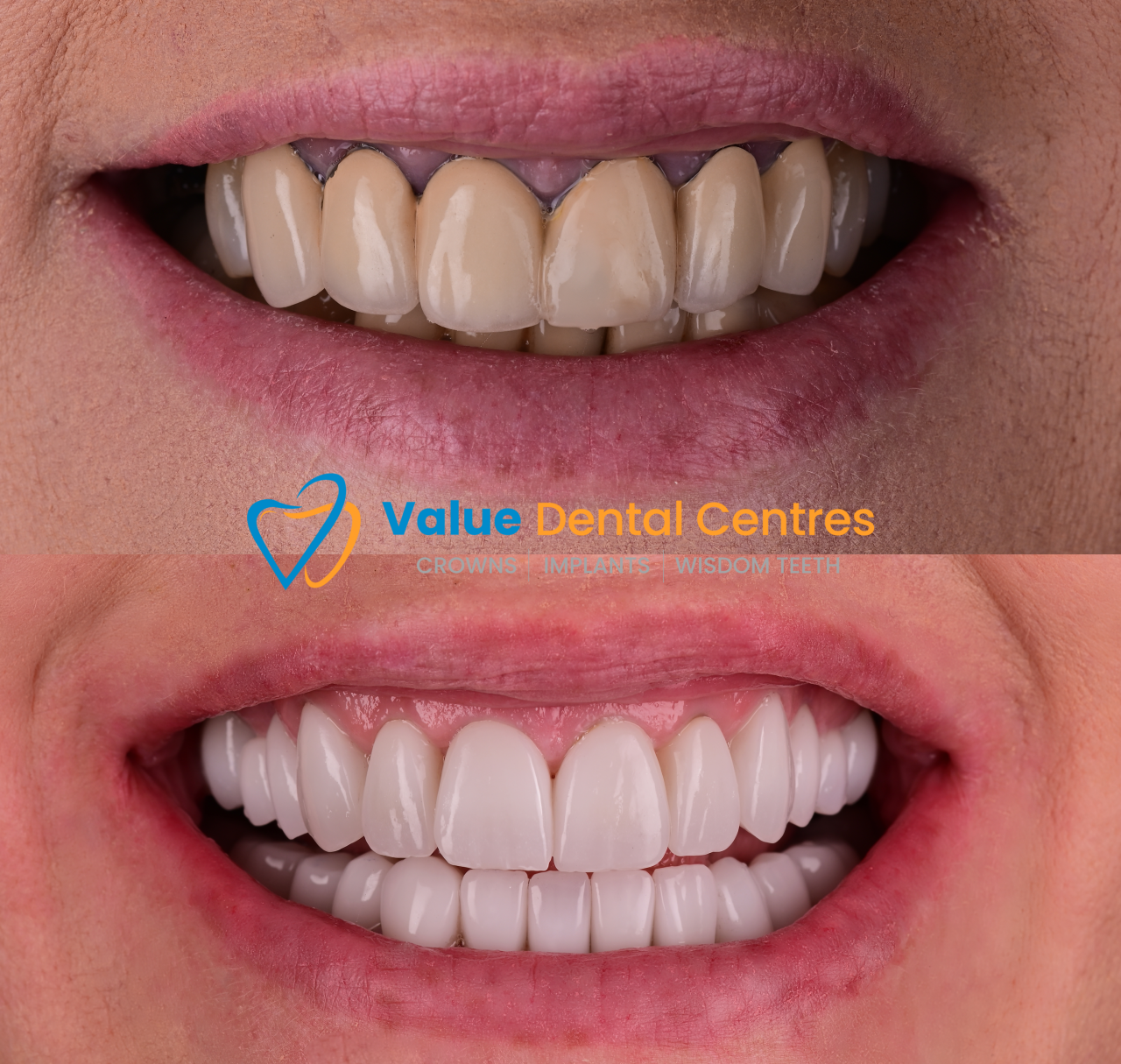 Maintaining Your Smile Makeover: An Optimal Diet for a Beautiful Smile