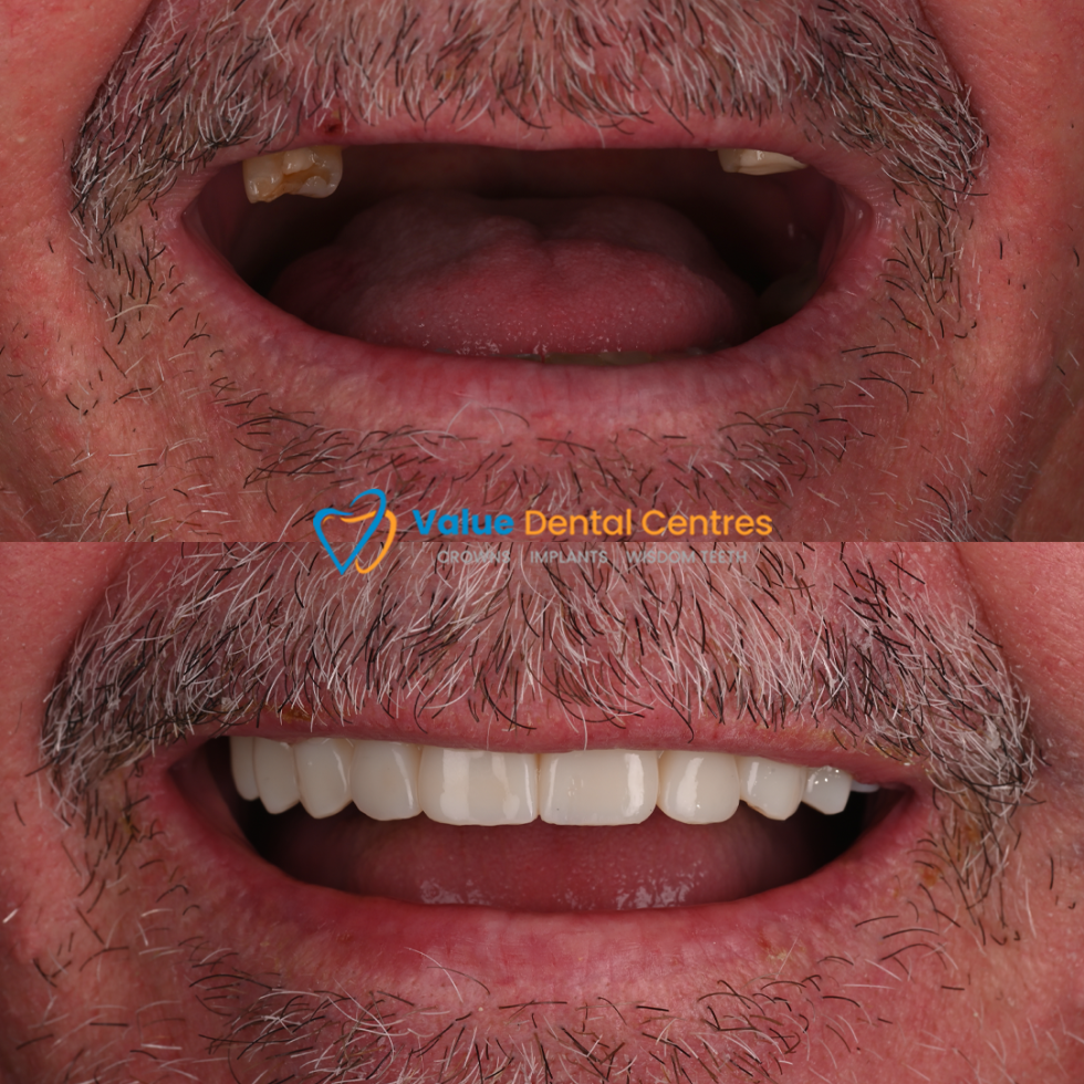 Full arch (All-on-X) Implant Treatment | Value Dental Centres