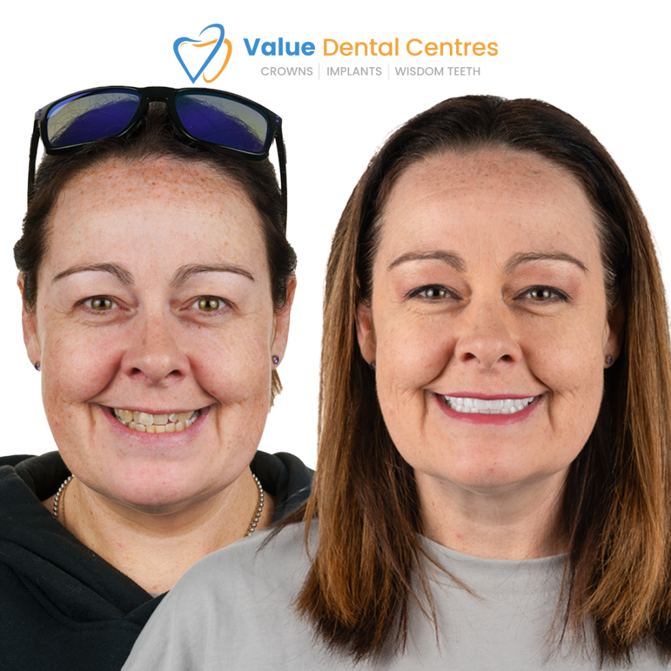 Full arch (All-on-X) Implant Treatment | Value Dental Centres
