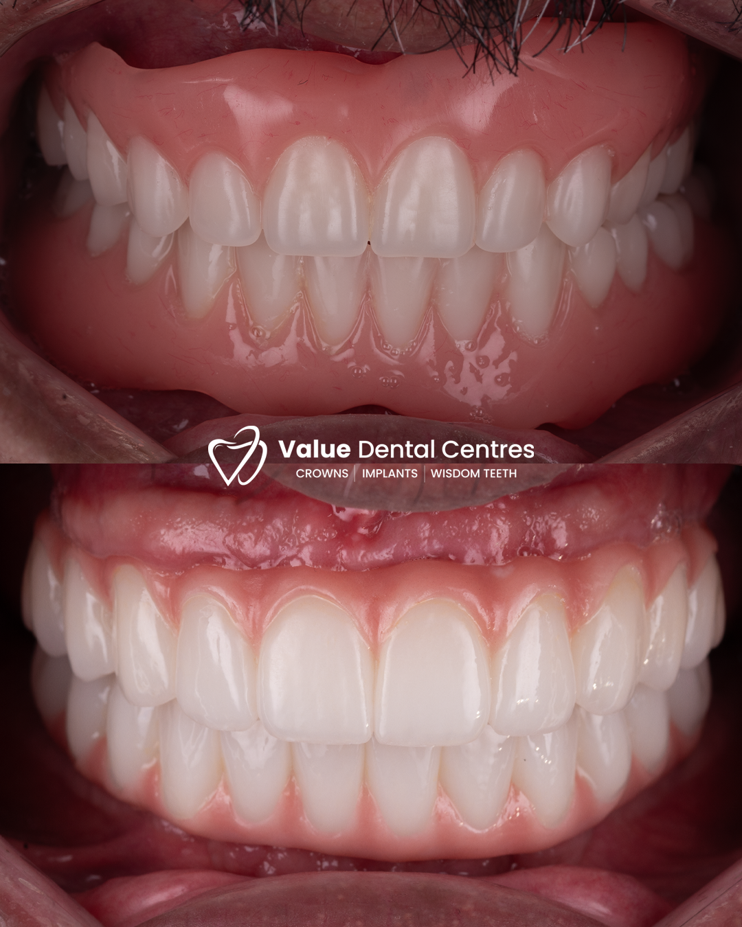 All-On-X Dental Implants: Guide to Benefits, Risks, and Planning ...